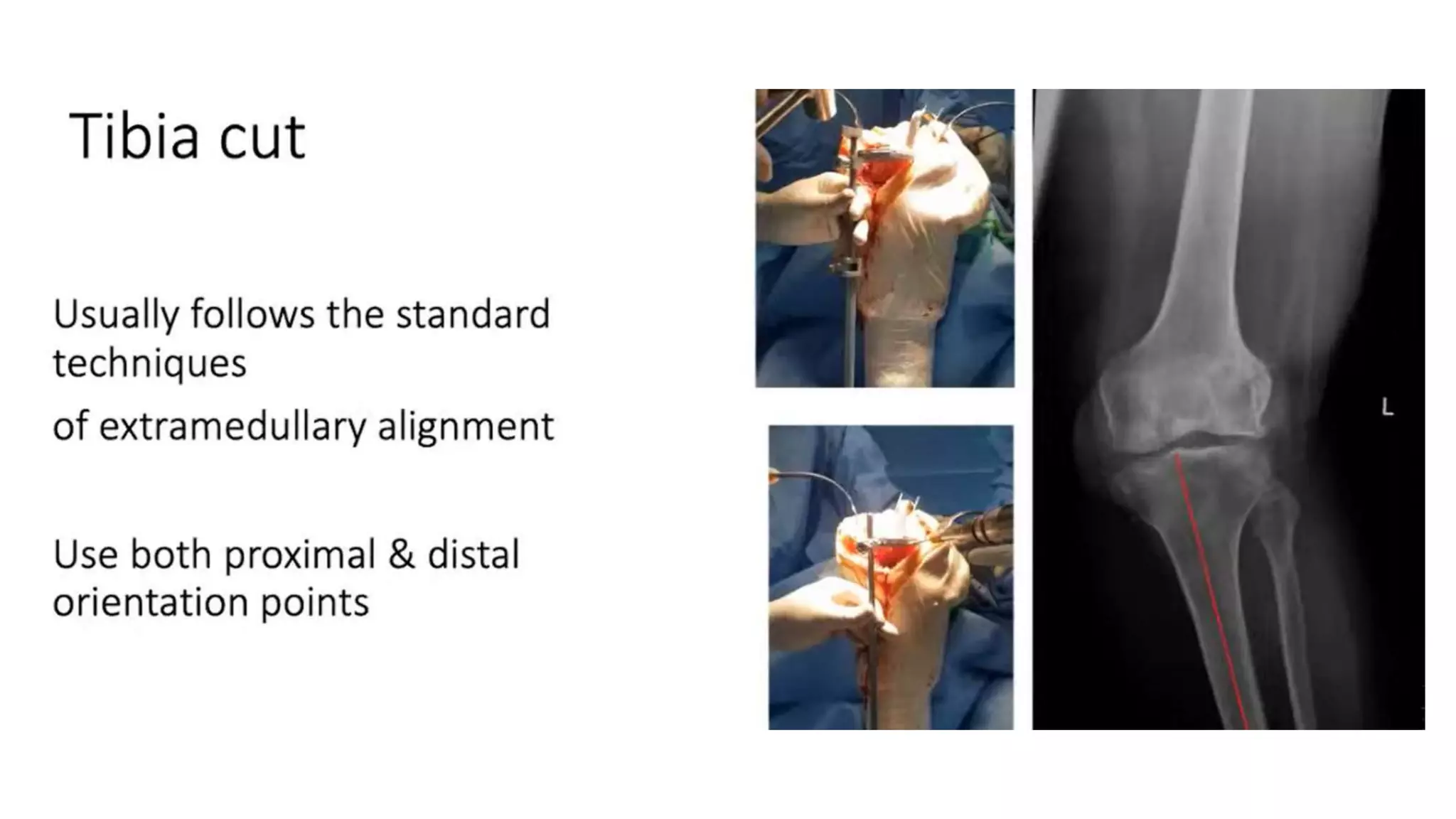 TKA in valgus knee.pptx