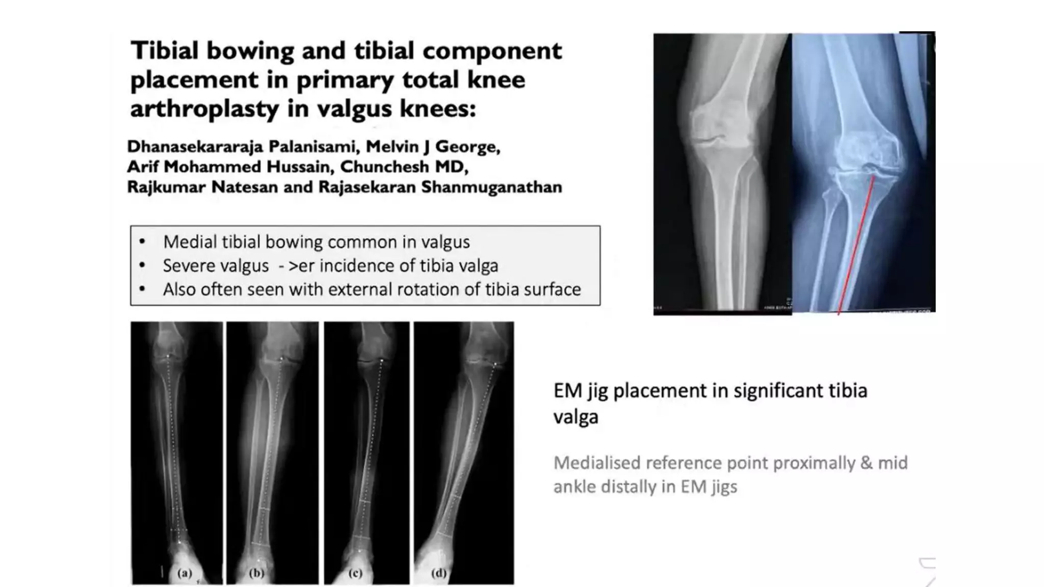 TKA in valgus knee.pptx