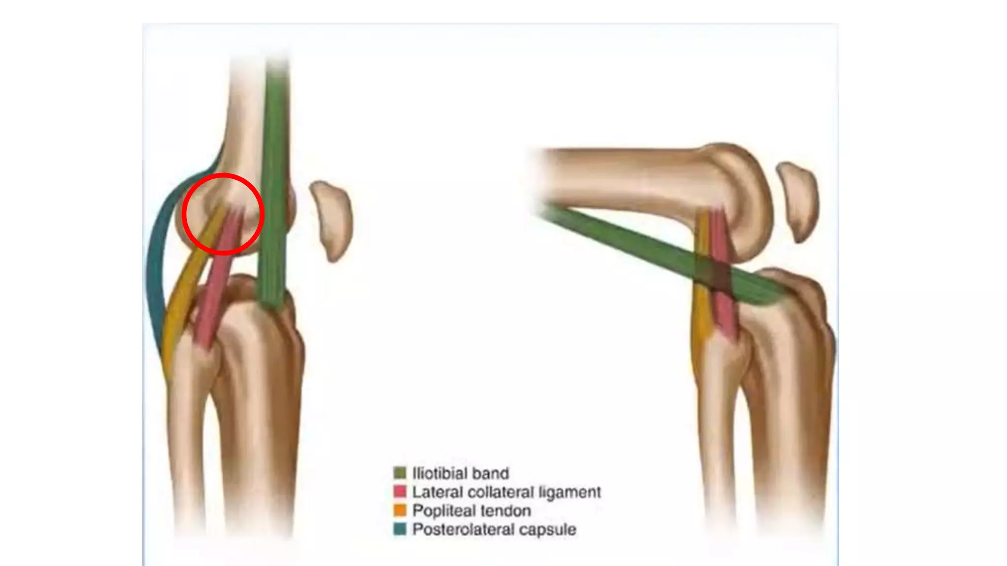 TKA in valgus knee.pptx