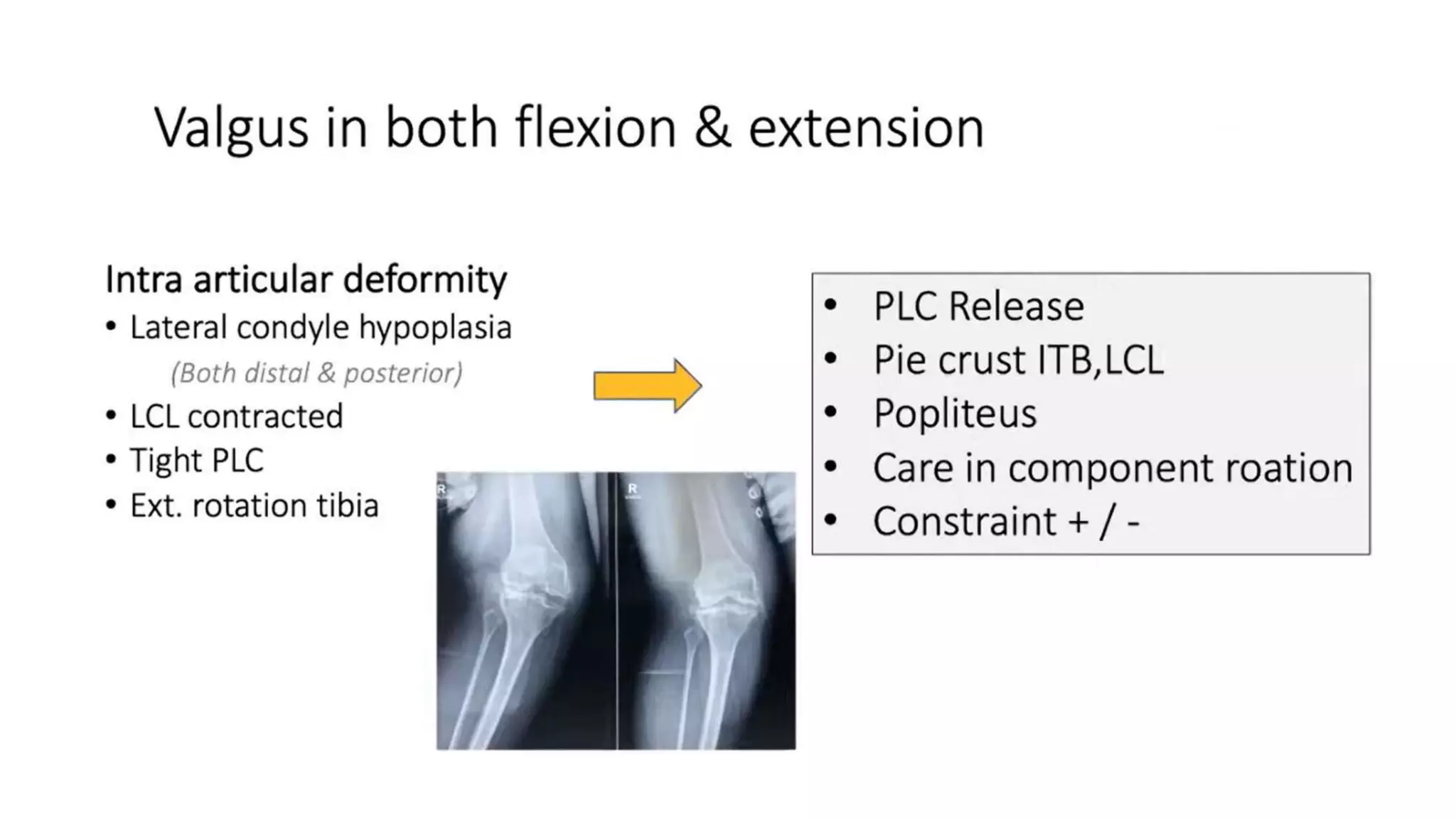 TKA in valgus knee.pptx