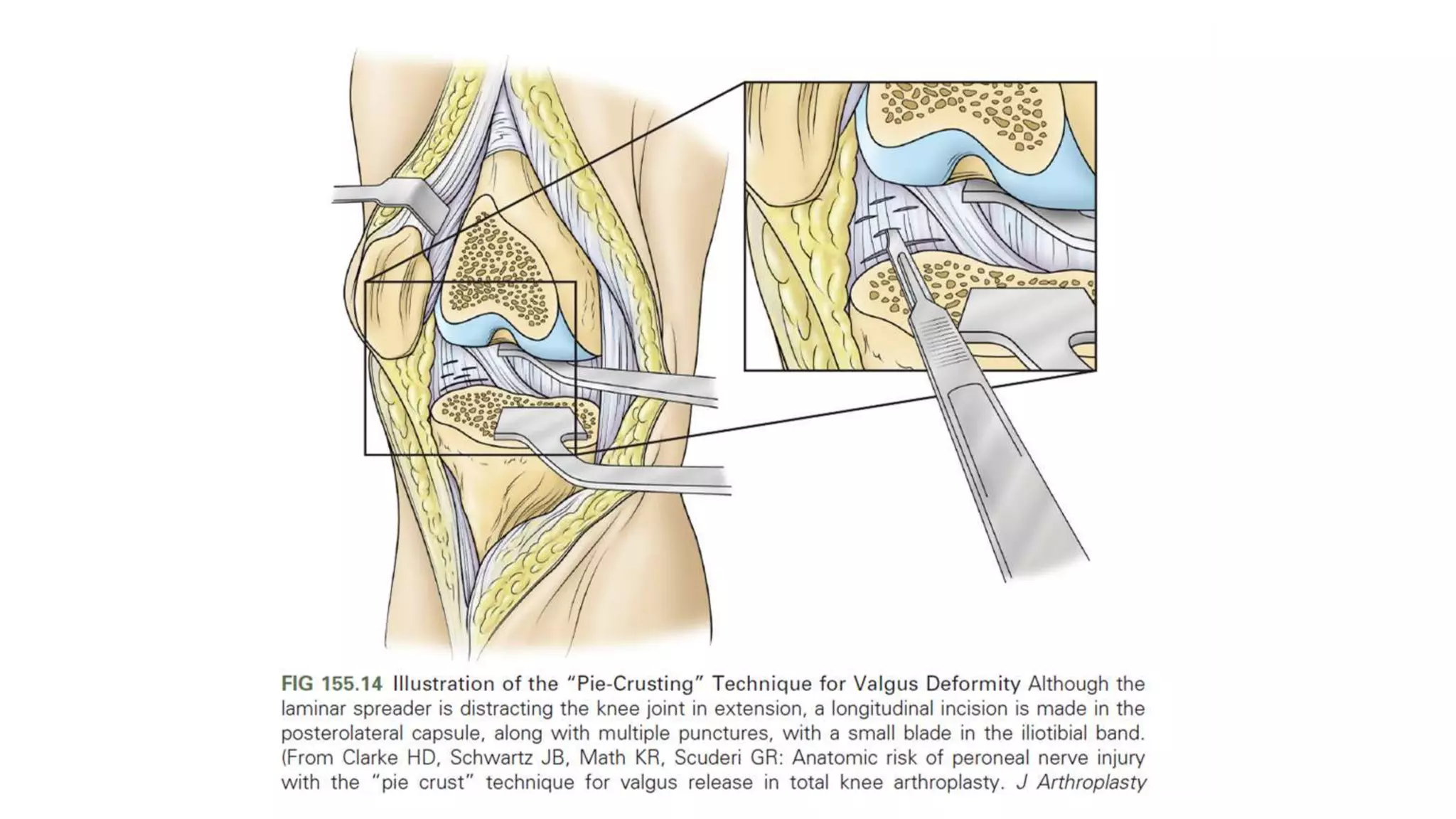 TKA in valgus knee.pptx