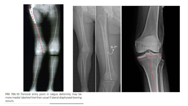 TKA in valgus knee.pptx