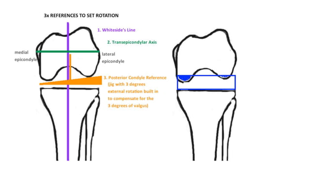TKA in valgus knee.pptx