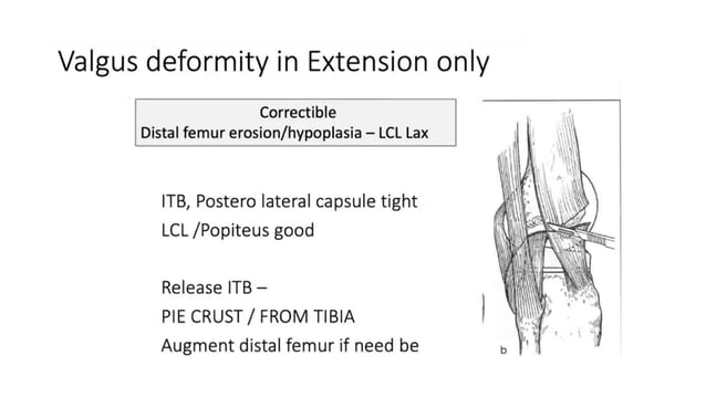 TKA in valgus knee.pptx