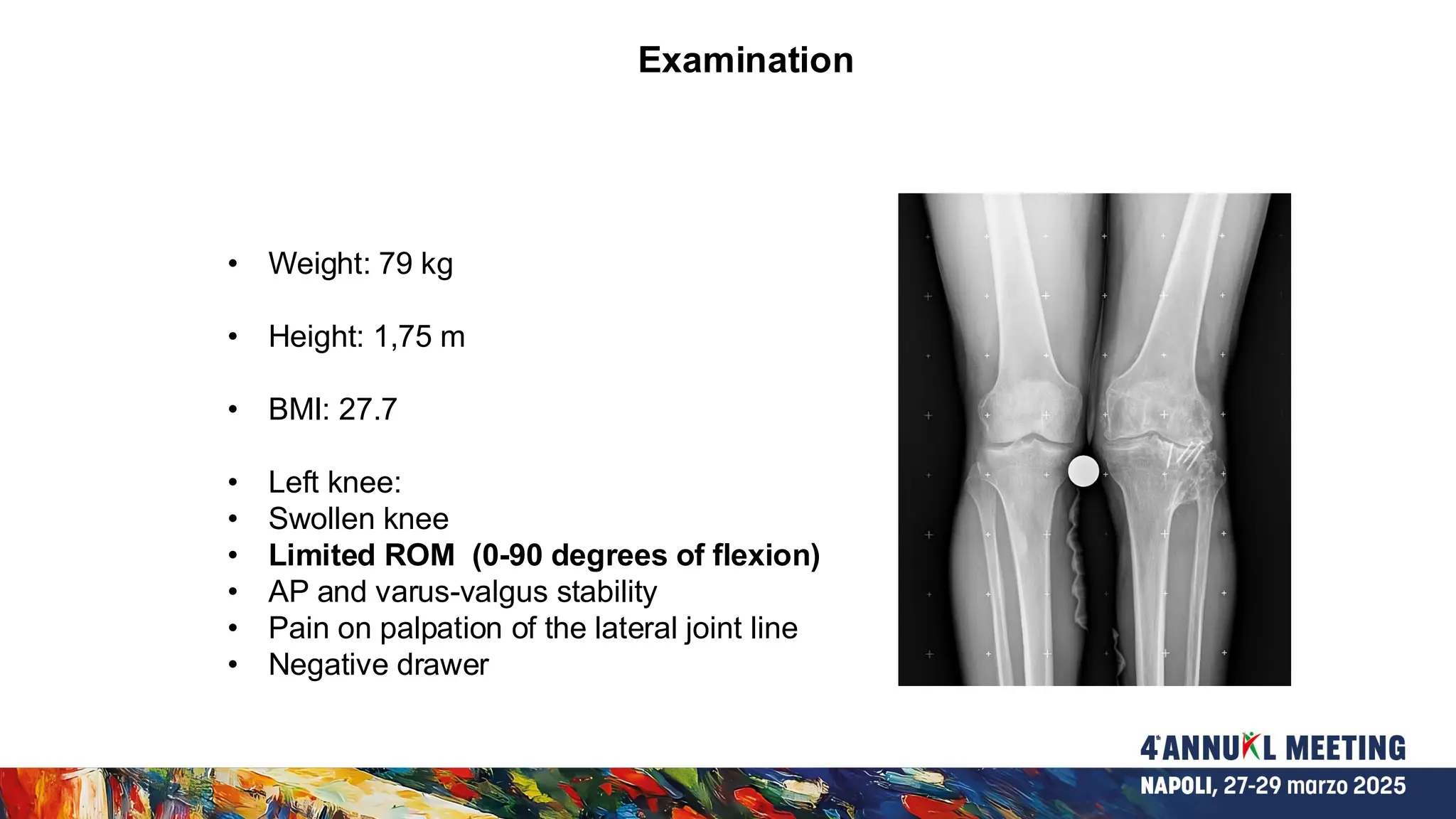 TKA in stiff knee - how to manage the right patient | PDF