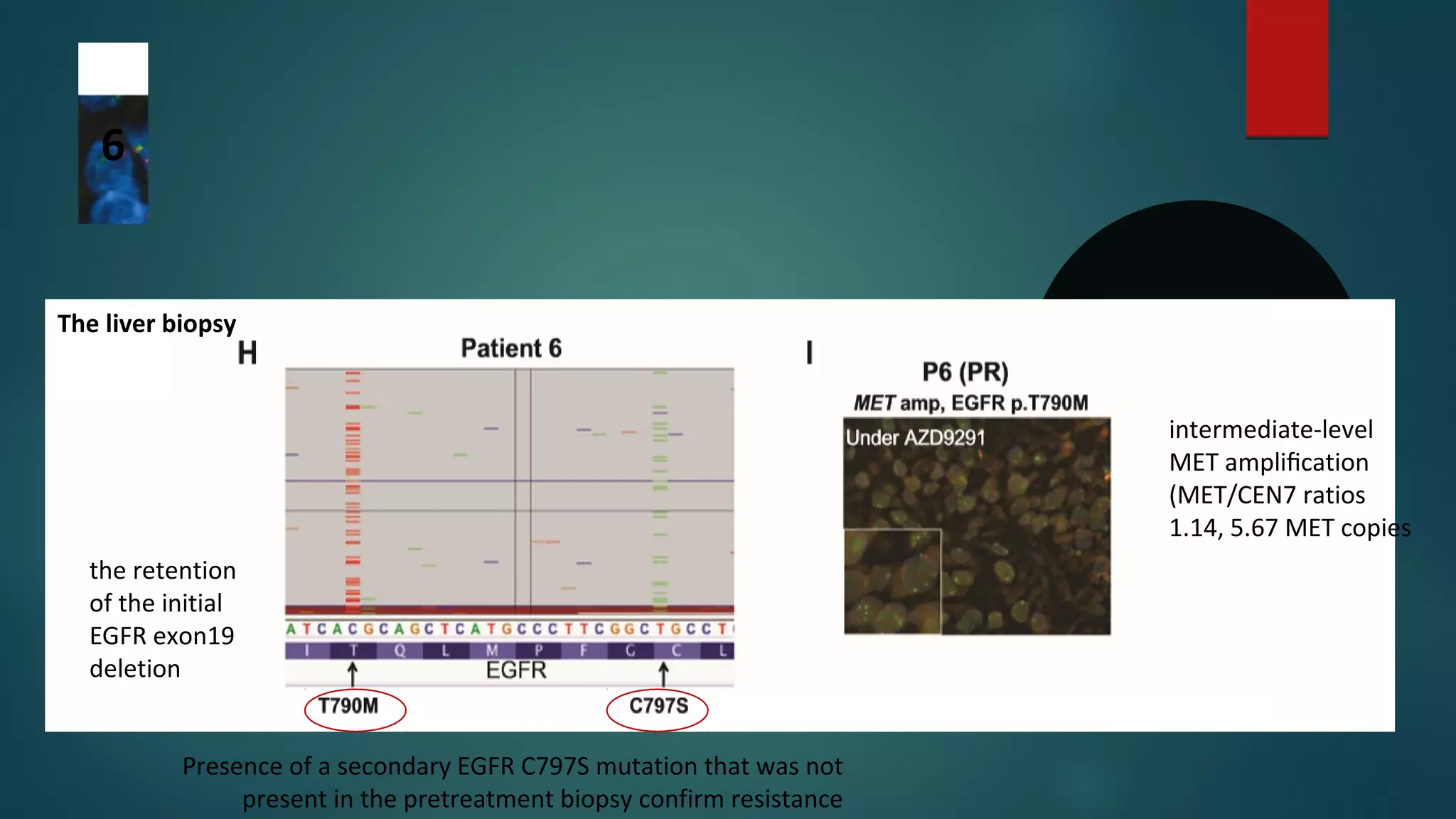 EGFR -TkI resistance pathways | ODP