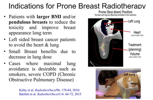 Immobilization and setup for Prone Breast Radiotherapy- A Therapist ...