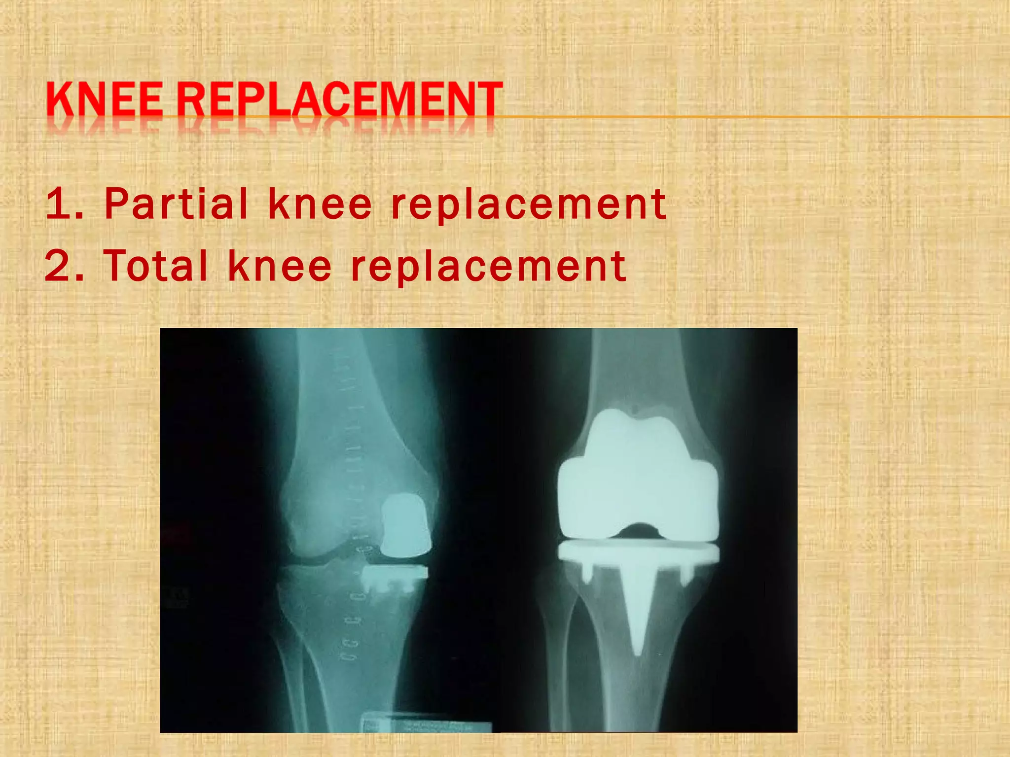 TOTAL KNEE REPLACEMENT | PPT