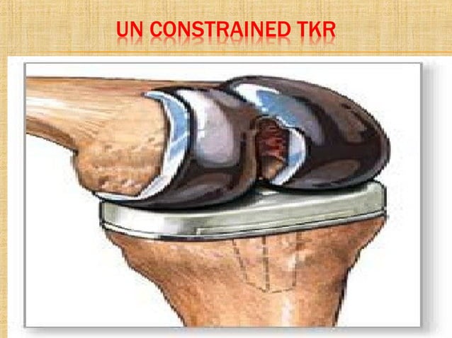 TOTAL KNEE REPLACEMENT | PPT | Death, Injury, or Military Conflict ...