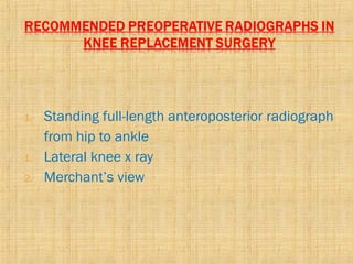 TOTAL KNEE REPLACEMENT | PPT