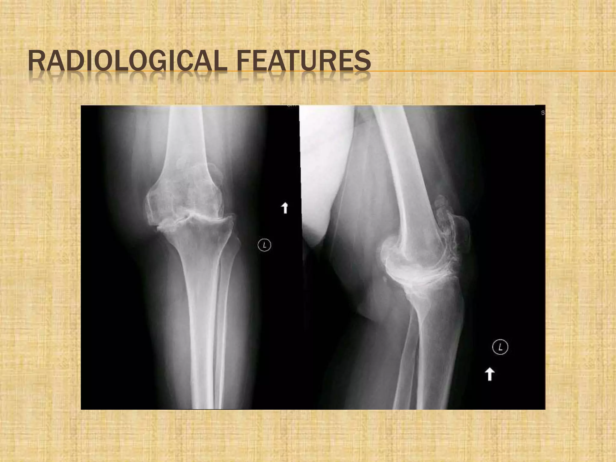 Total Knee Replacement (TKR) | PPT