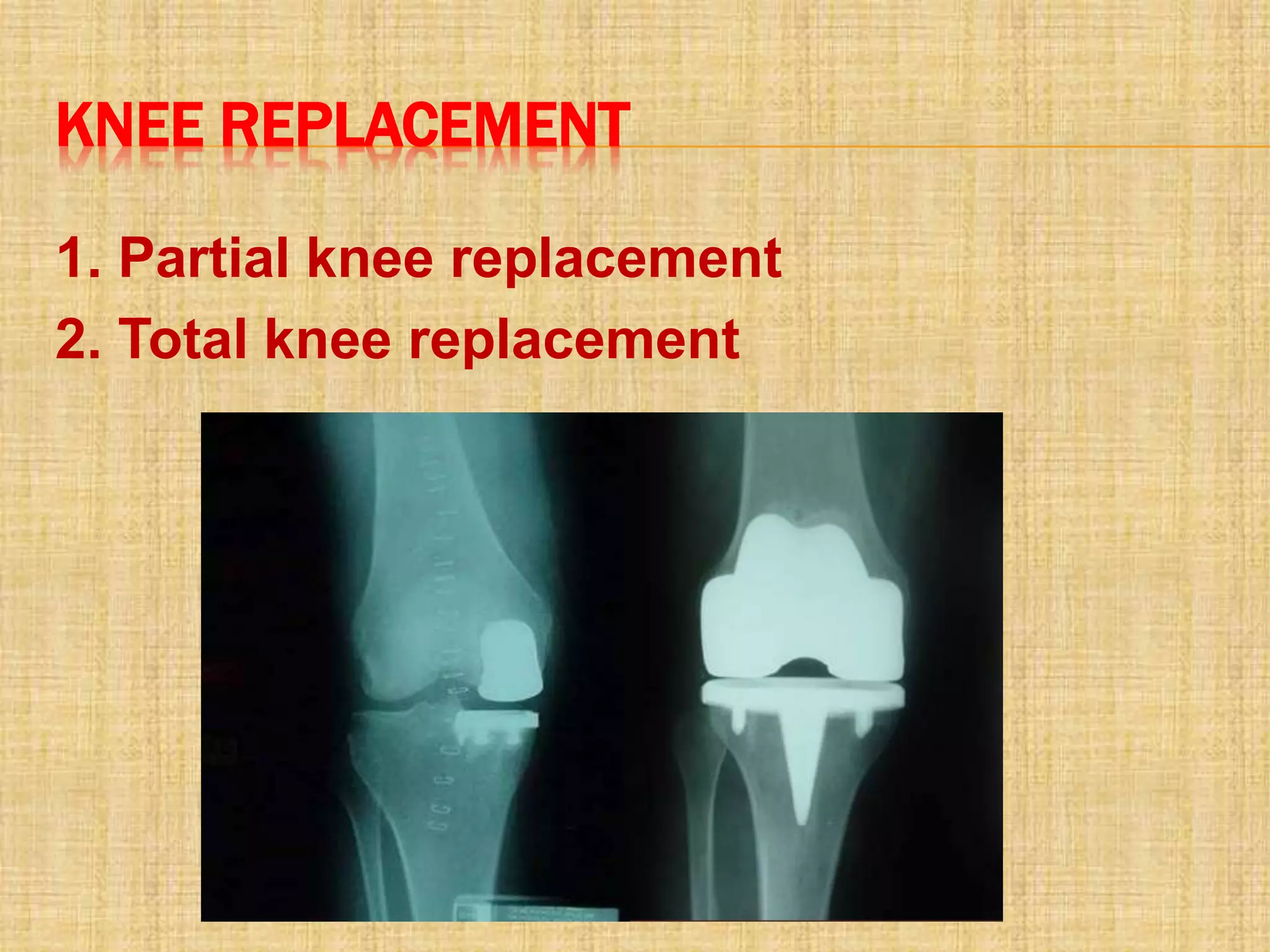 Total Knee Replacement (TKR) | PPT