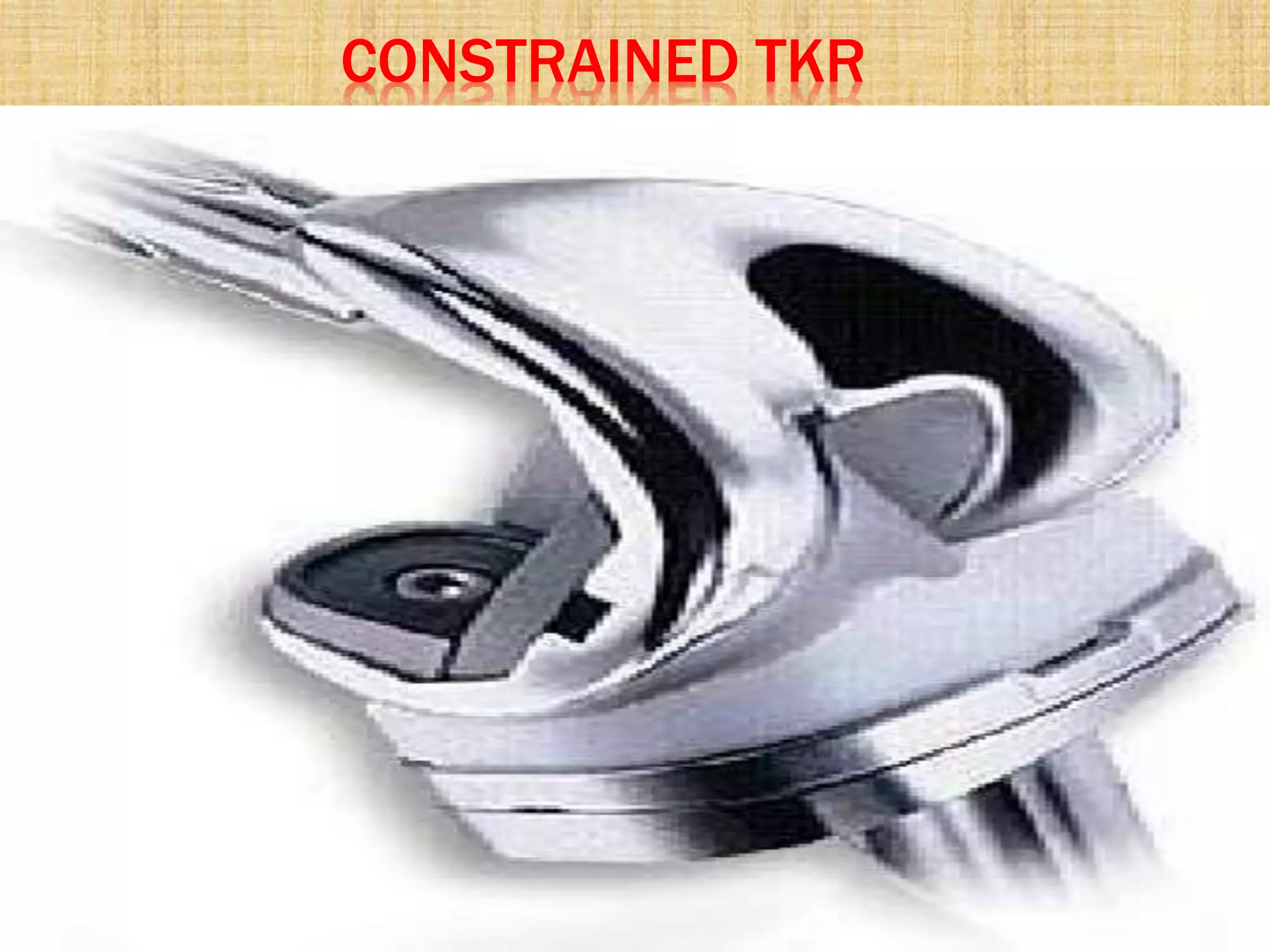 Total Knee Replacement (TKR) | PPT