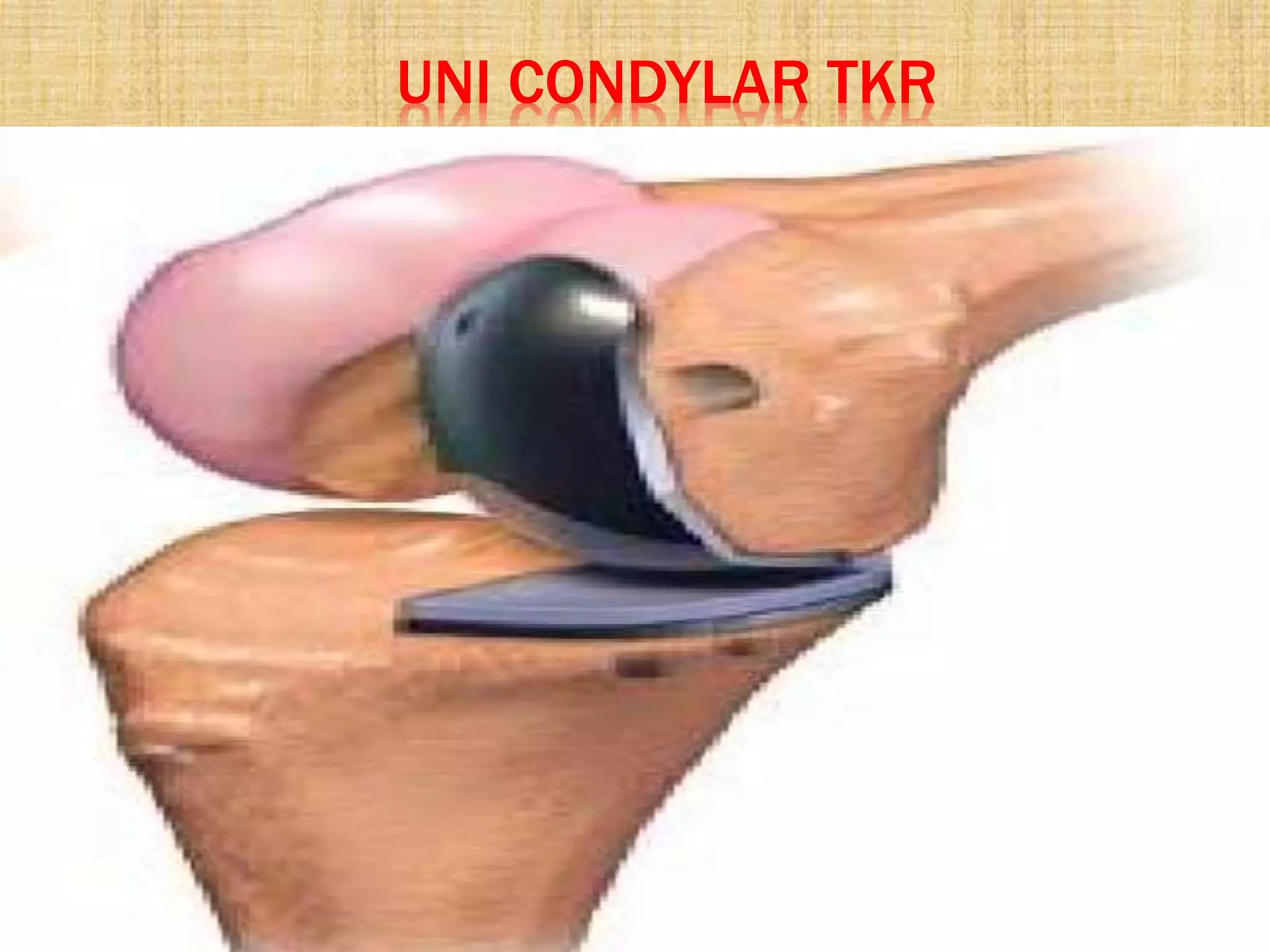 Total Knee Replacement (TKR) | PPT