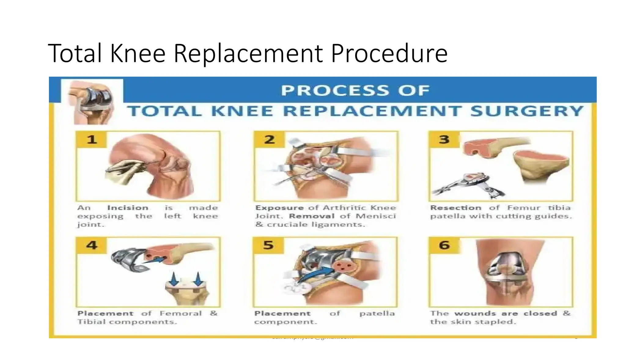 Role of physiotherapy in Total Knee Replacement.pptx
