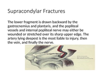 TKR AND LL Fracture By Dr.Rana.M.Shoaib.pptx