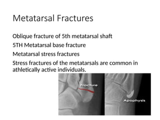 TKR AND LL Fracture By Dr.Rana.M.Shoaib.pptx