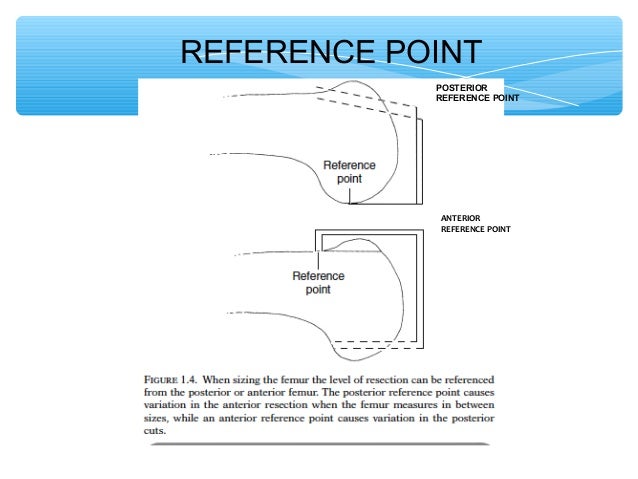 Total Knee Replacement