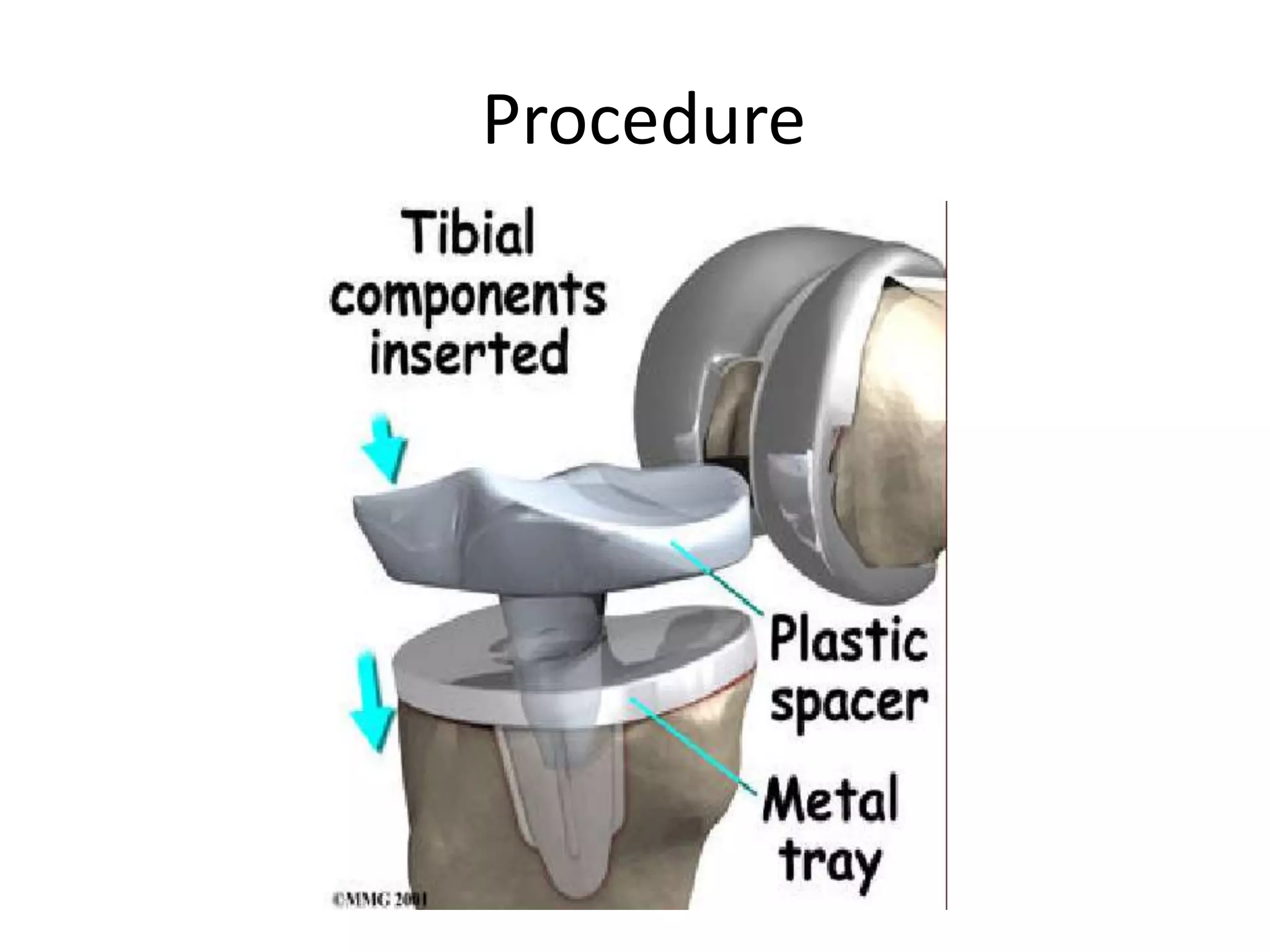 Tkr by dr. saumya agarwal | PPTX