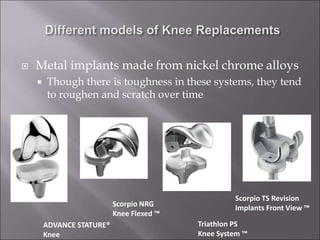Total Knee Replacement (TKR) in advanced arthritis | PPT