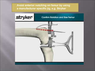Total Knee Replacement (TKR) in advanced arthritis | PPT