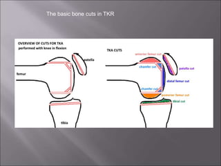 Total Knee Replacement (TKR) in advanced arthritis | PPT