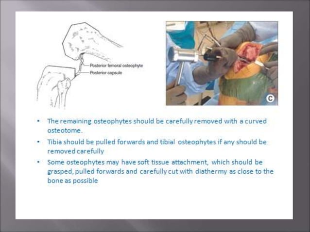 Total Knee Replacement (TKR) in advanced arthritis | PPT