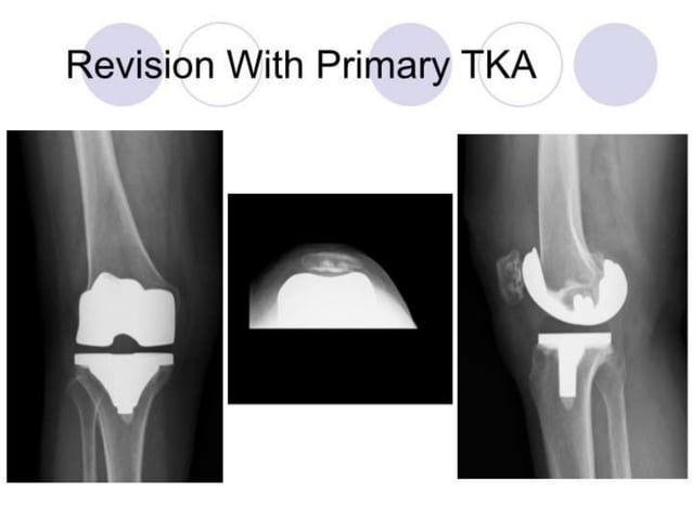 TKR For Failed Uniknee Replacement Surgery Dr Sandeep Agrawal Agrasen ...