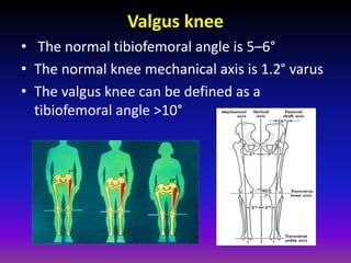TKR in valgus knee.pptx