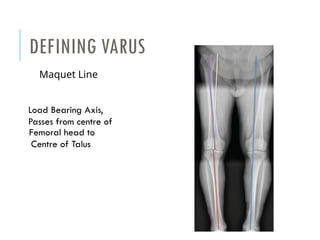 total knee arthroplasty in varus knee.pptx
