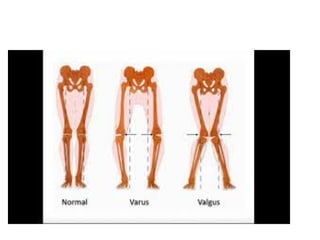 Total Knee replacement IN VARUS KNEE.pptx