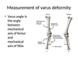Total Knee replacement IN VARUS KNEE.pptx
