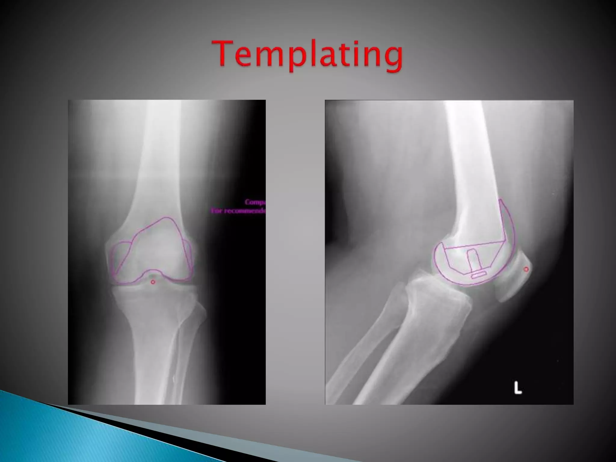 Tkr operative | PPTX