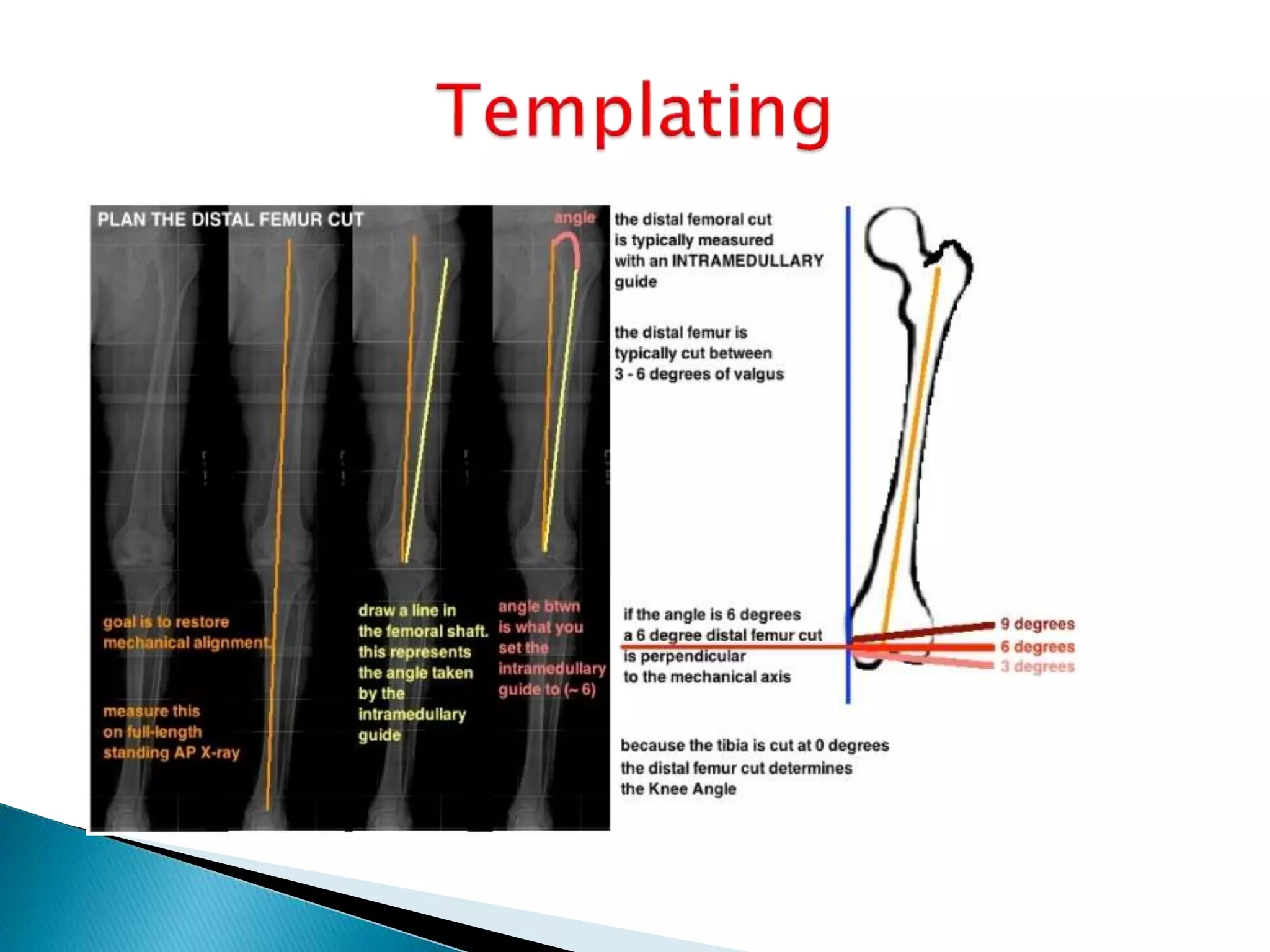 Tkr operative | PPTX