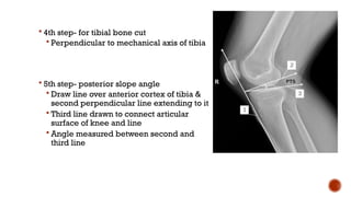 Total Knee Replacement/ arthroplasty ppt.pptx
