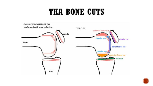 Total Knee Replacement/ arthroplasty ppt.pptx