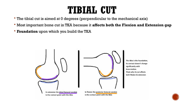 Total Knee Replacement/ arthroplasty ppt.pptx