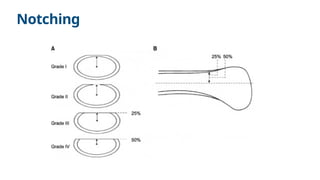 TKR Templating- Hari.pptxbsbdnfnndnsnsndnnfnf | PPTX