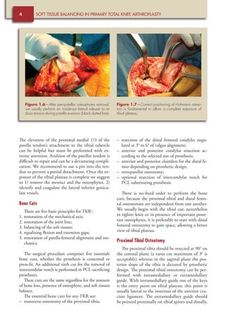 soft tissue balancing in tkr | PDF