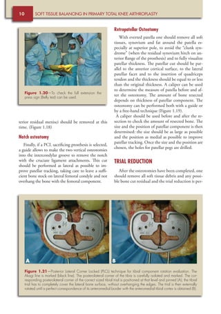 soft tissue balancing in tkr | PDF