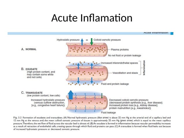 Acute and Chronic inflammation from Robins Basic pathology | PPTX ...