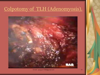 TOTAL LAPAROSCOPIC HYSTERECTOMY | PPT