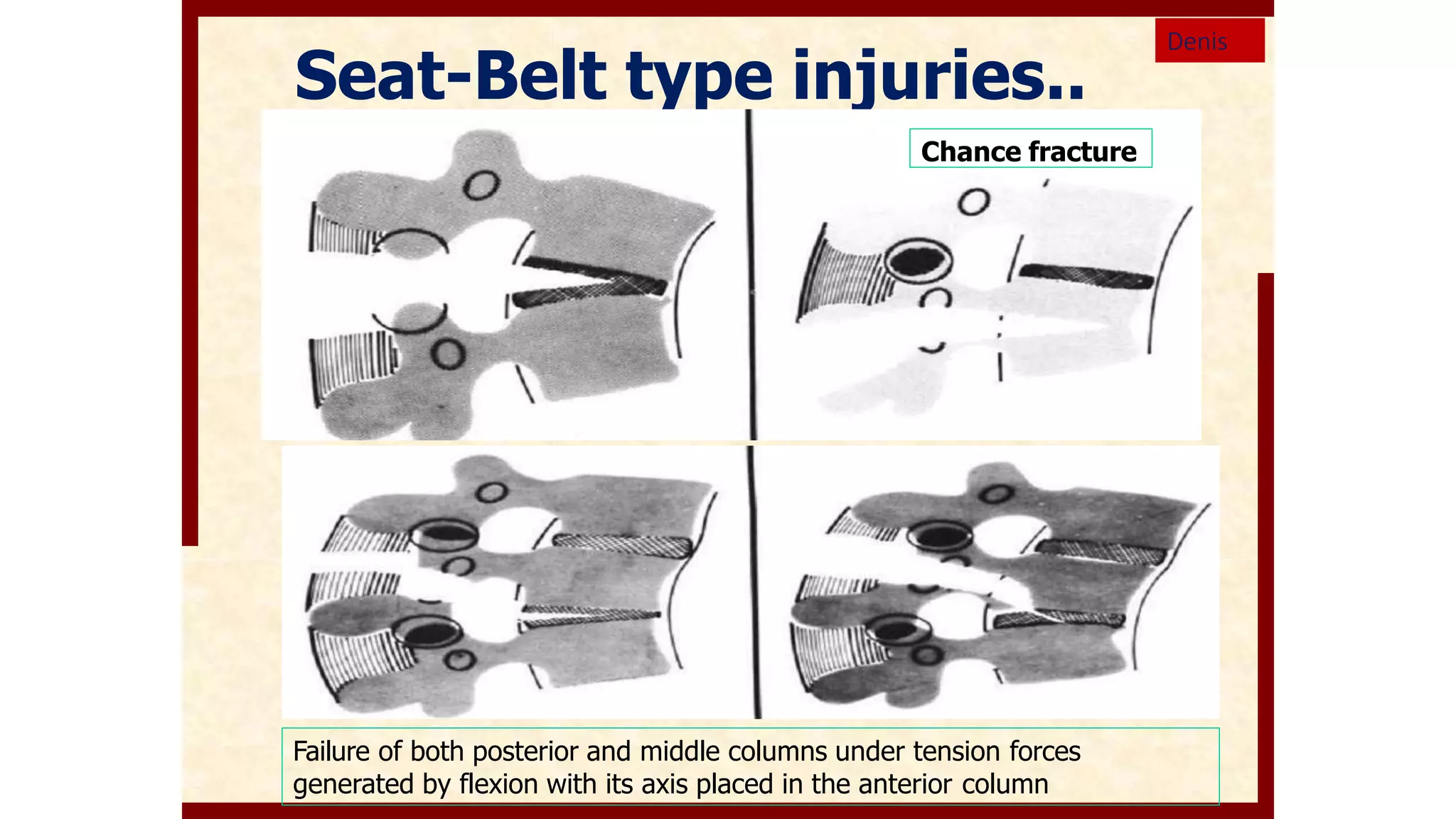 THORACOLUMBAR SPINE INJURIES | PPTX