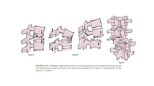 THORACOLUMBAR SPINE INJURIES | PPTX