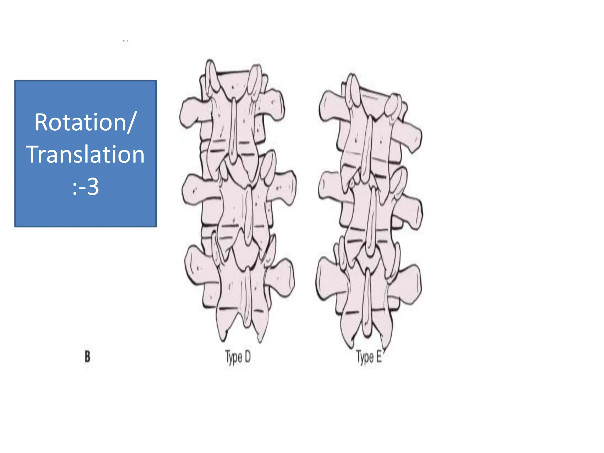 thoracolumbar injury classification severity score .pptx