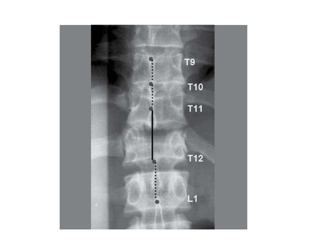 thoracolumbar injury classification severity score .pptx