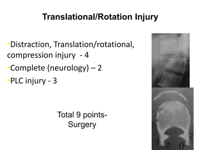 thoracolumbar injury classification severity score .pptx