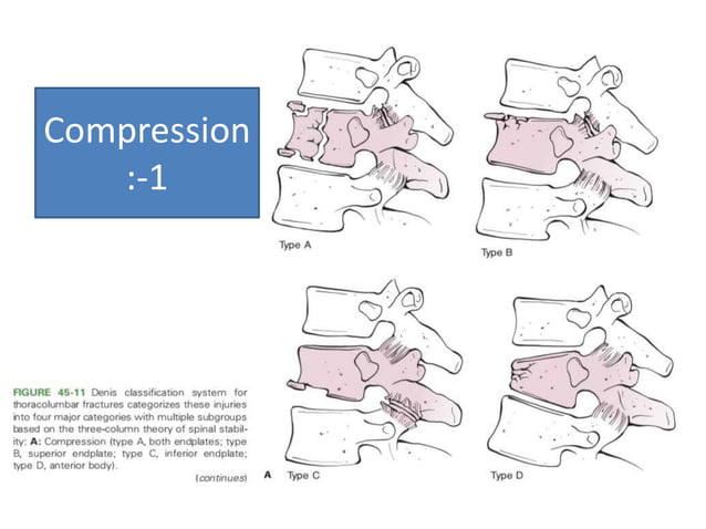 thoracolumbar injury classification severity score .pptx