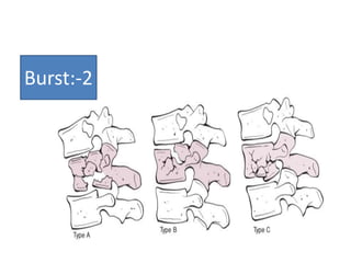 thoracolumbar injury classification severity score .pptx