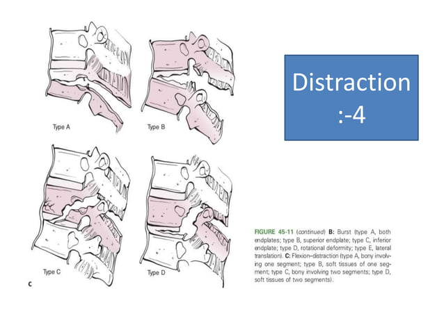 thoracolumbar injury classification severity score .pptx